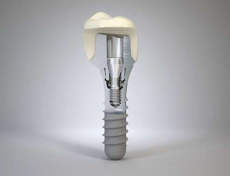 Straumann - We Know Smiles